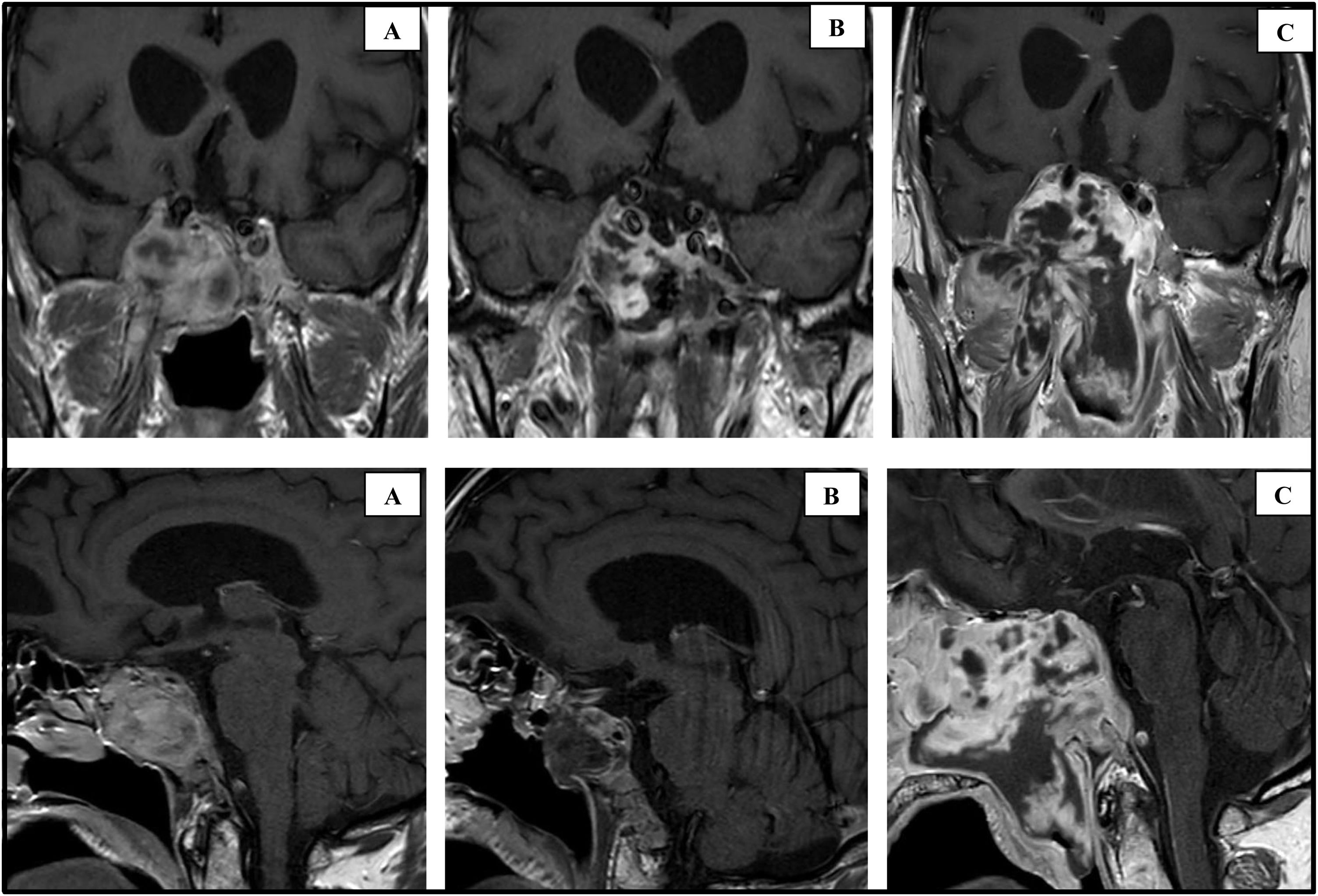 Sarcomatous transformation of a silent corticotroph adenoma after ...