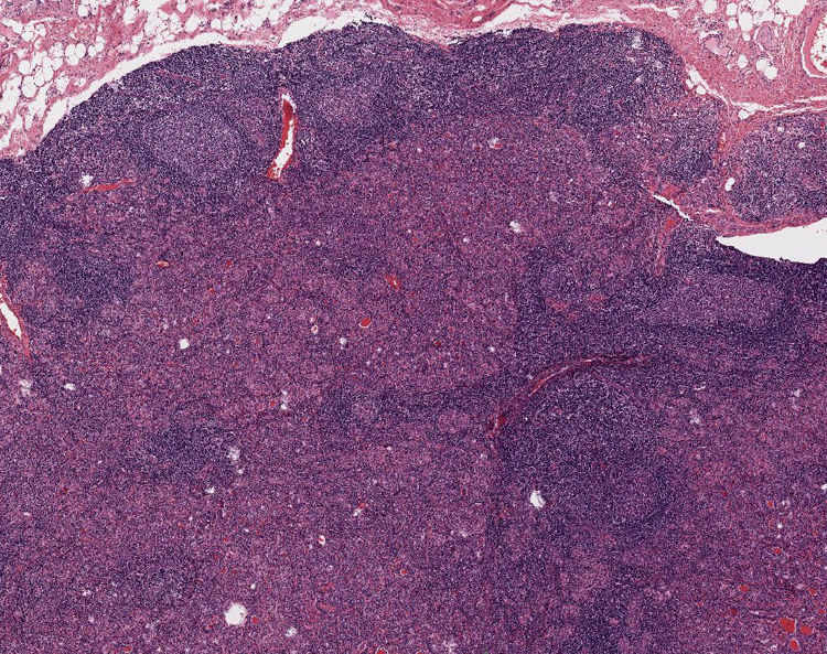 ectopic thyroid pathology outlines