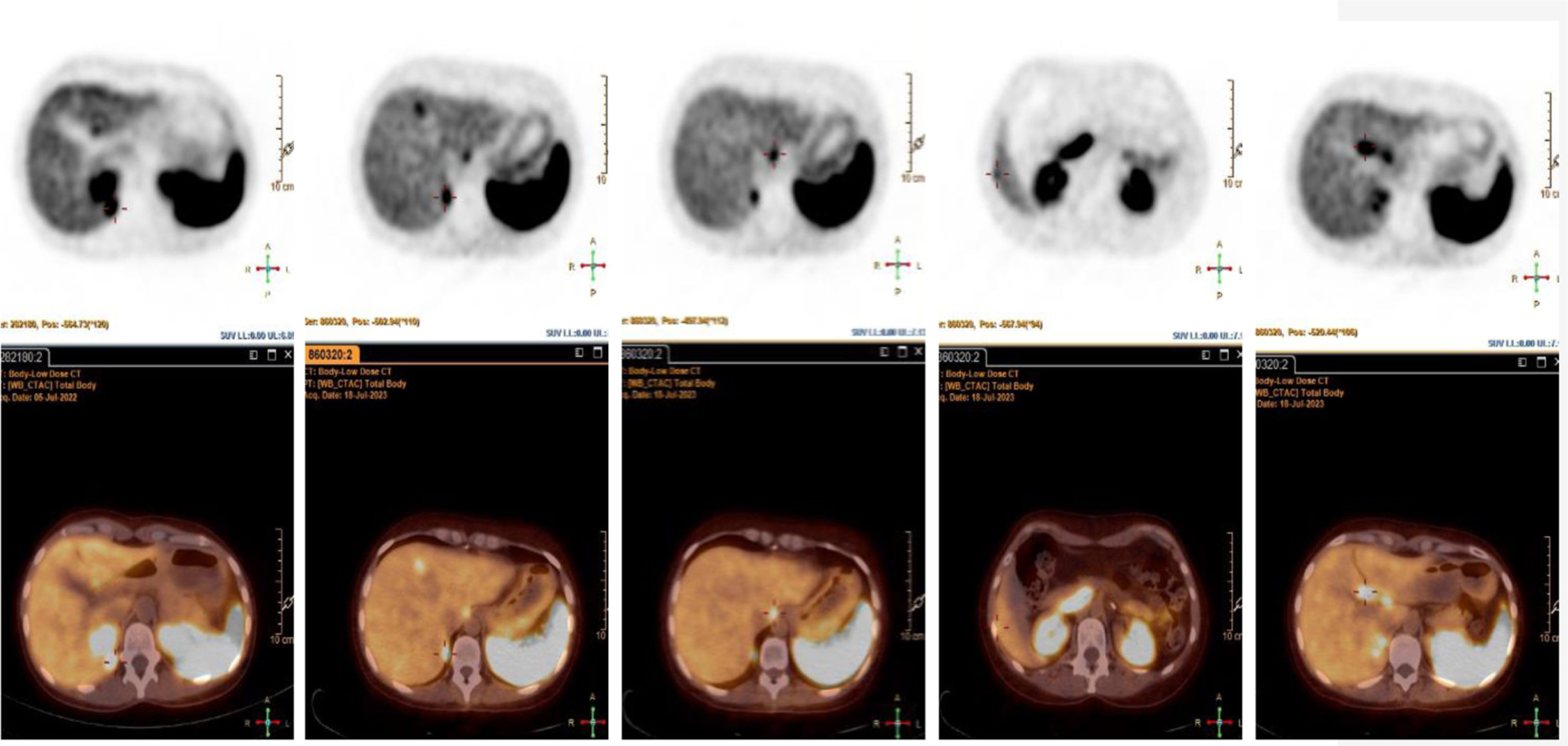 TMEM-127 gene mutation: A rare genetic entity associated with ...