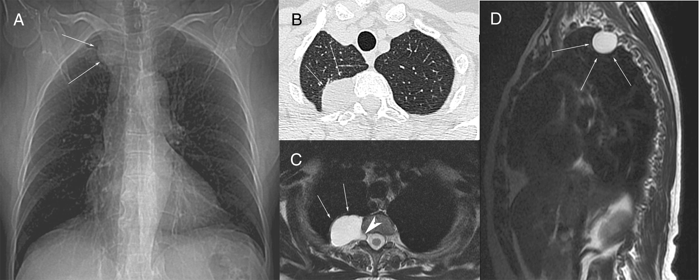 Tarlov cyst: A rare cause of posterior mediastinal mass | Pulmonology