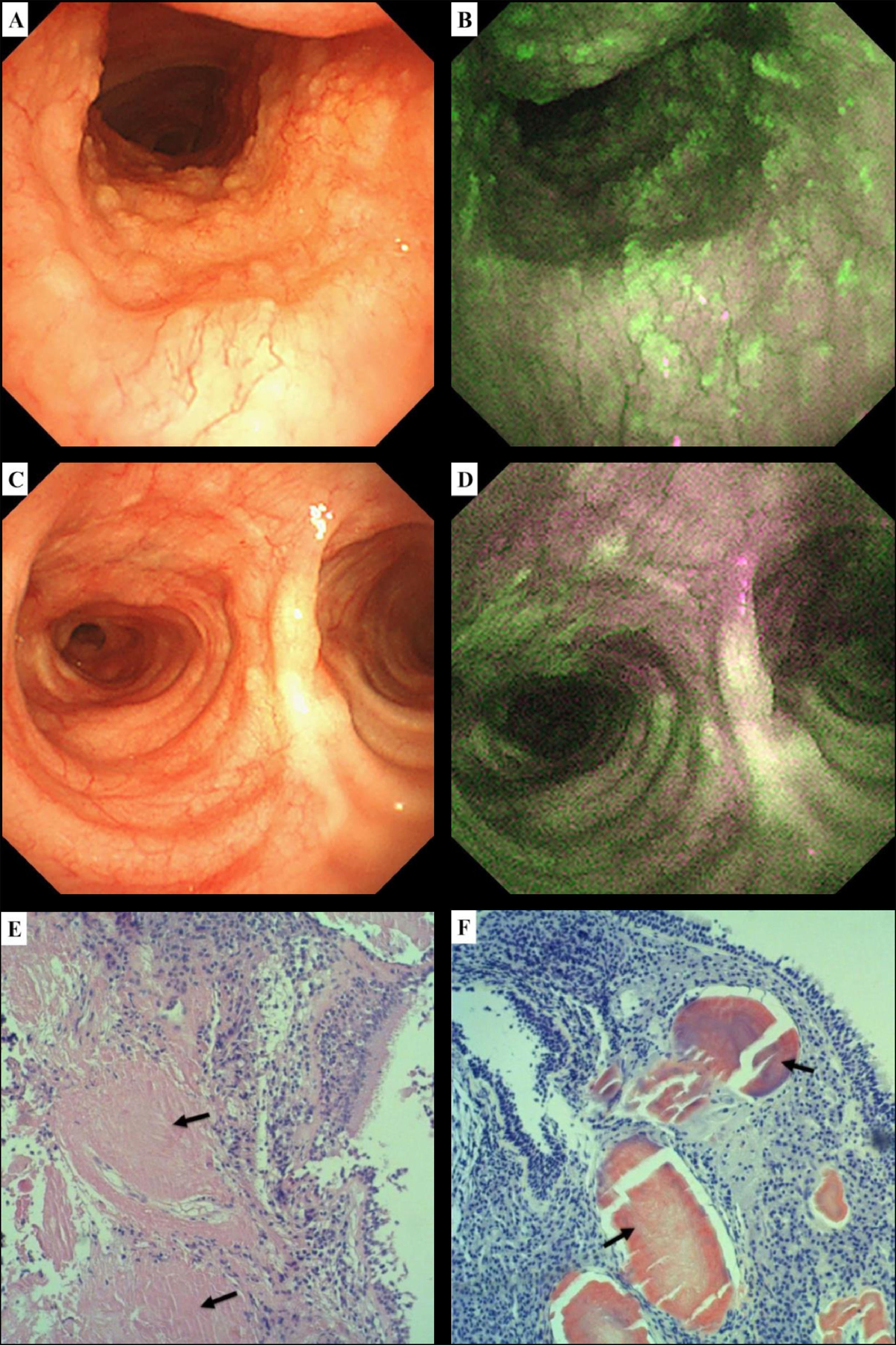 Tracheal amyloidosis visualized by autofluorescence endoscopy | Pulmonology