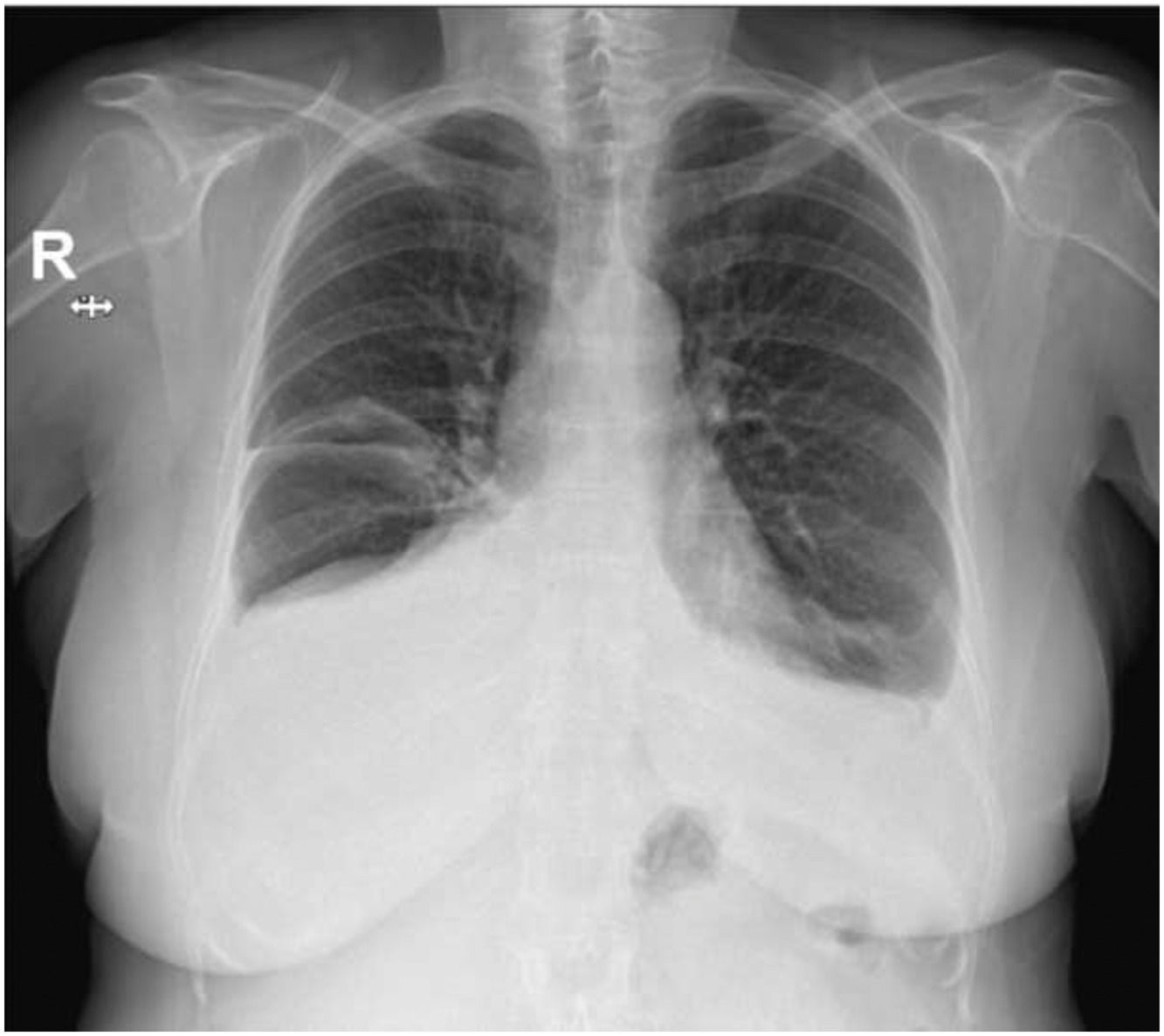Chylothorax as an unusual presentation of Bosutinib therapy toxicity ...