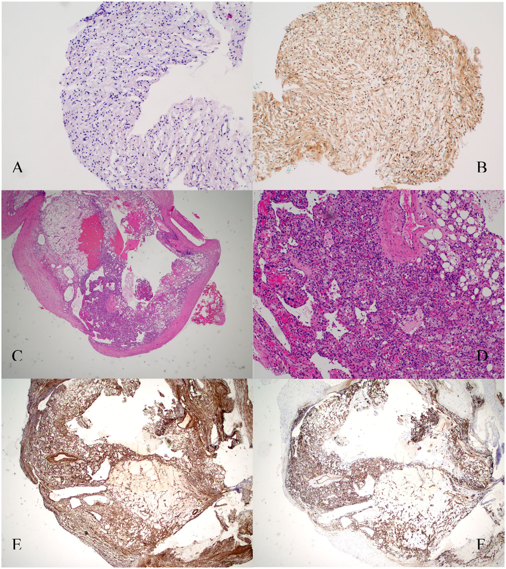 Prevascular mediastinal angyomiolipoma. A case report | Pulmonology