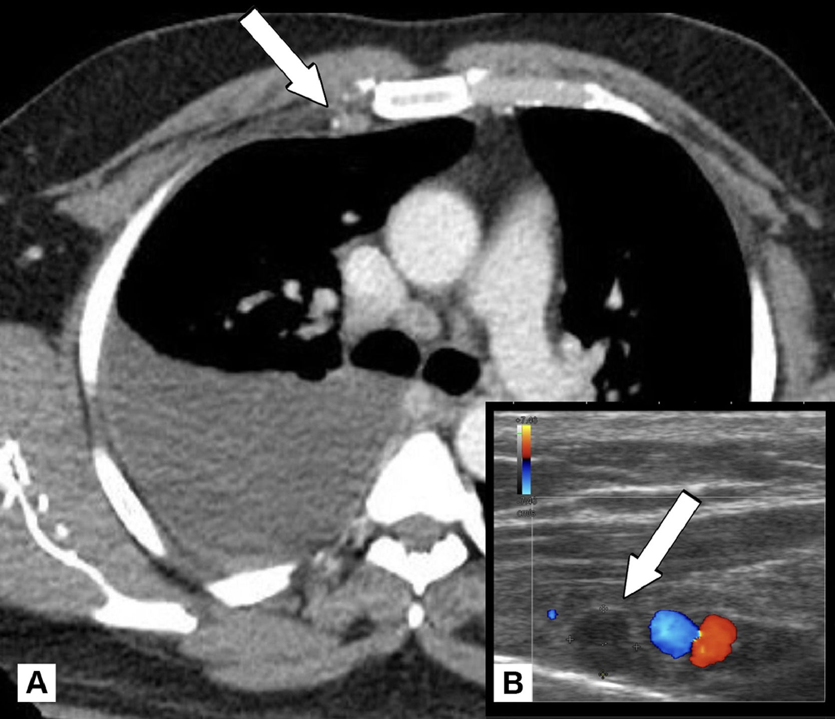 Diagnostic role of internal mammary lymph node involvement in ...