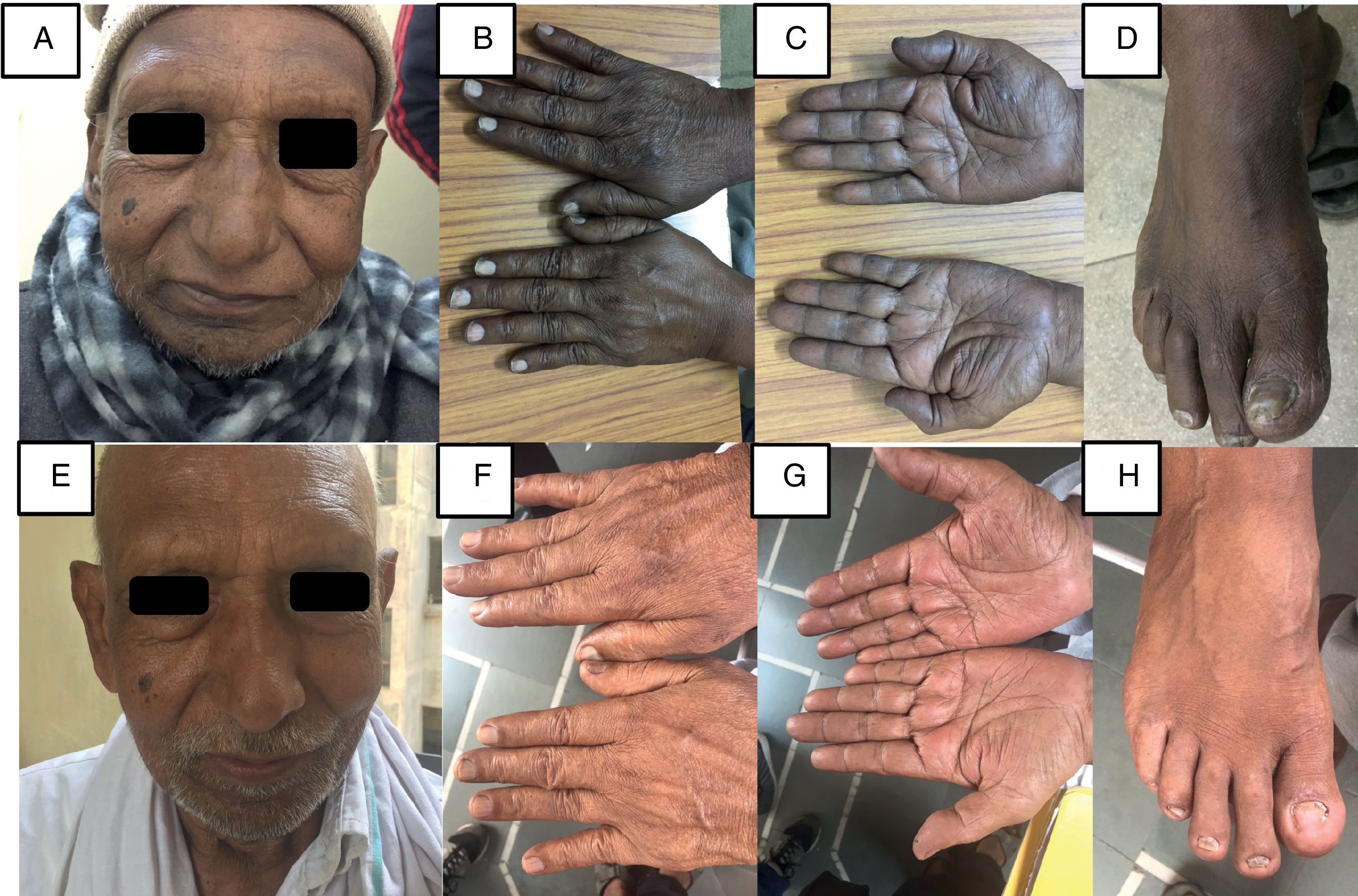 Bleomycin induced hyperpigmentation of skin | Hematology, Transfusion ...