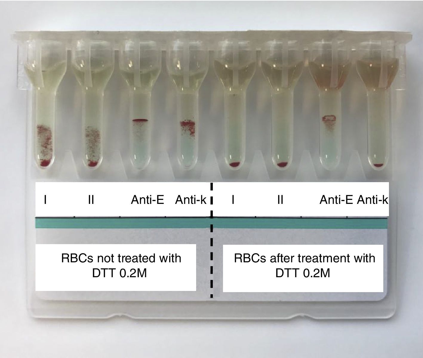 Transfusion management for patients taking an anti-CD38 monoclonal ...