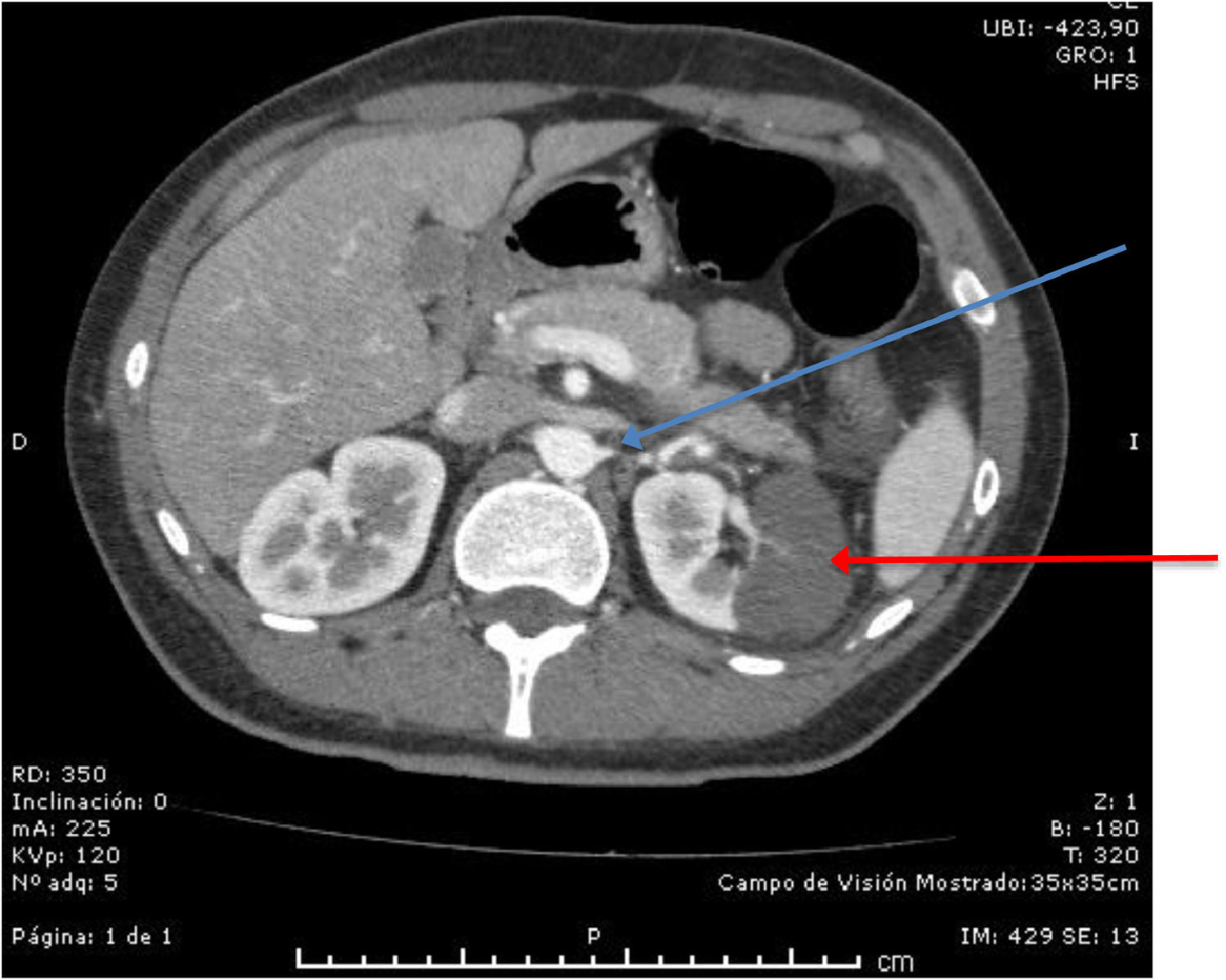 Renal infarction associated with asymptomatic Covid-19 infection ...