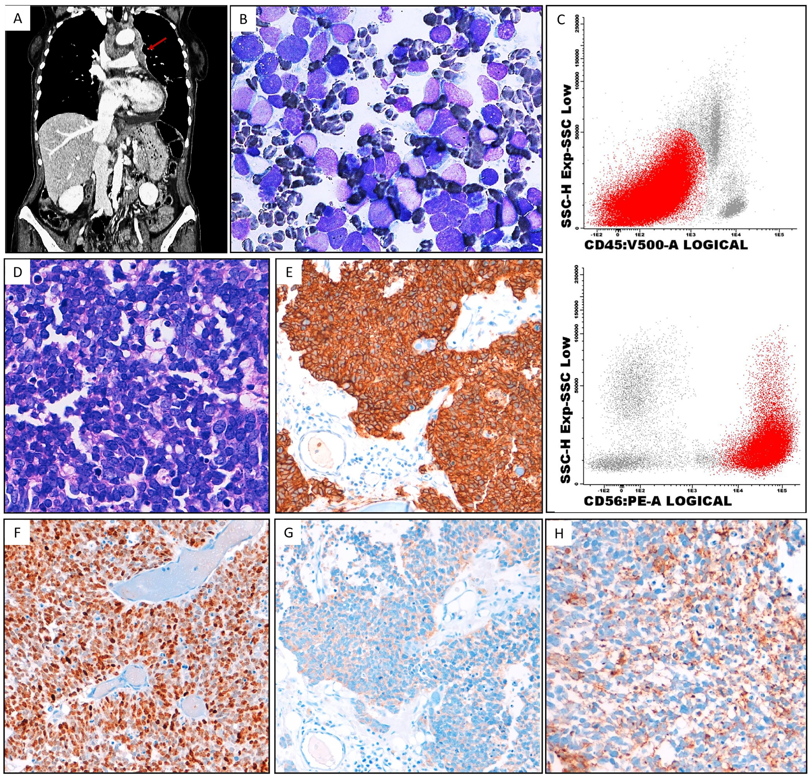 Bone marrow involvement in small cell lung cancer | Hematology ...