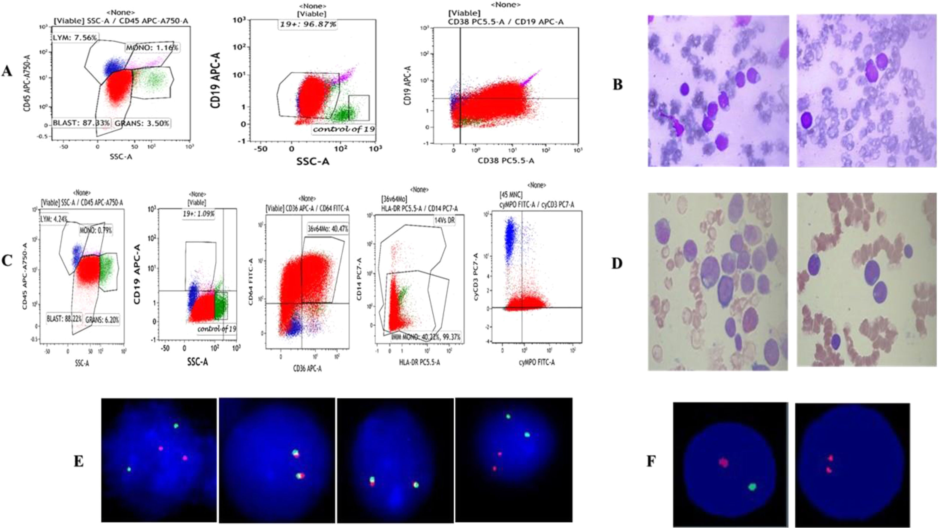Acute lymphoblastic leukemia to acute myeloid leukemia: an unusual case ...