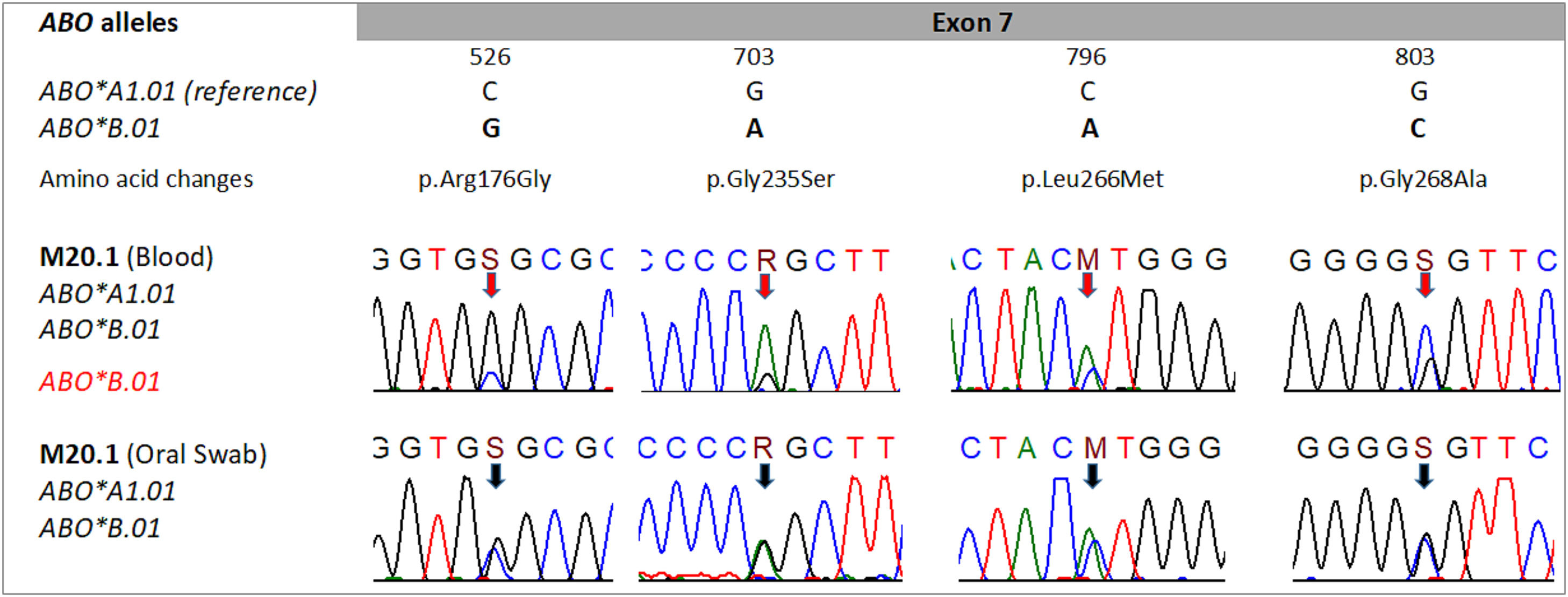 Mixed field resolution in ABO phenotyping in a rare case of a blood ...