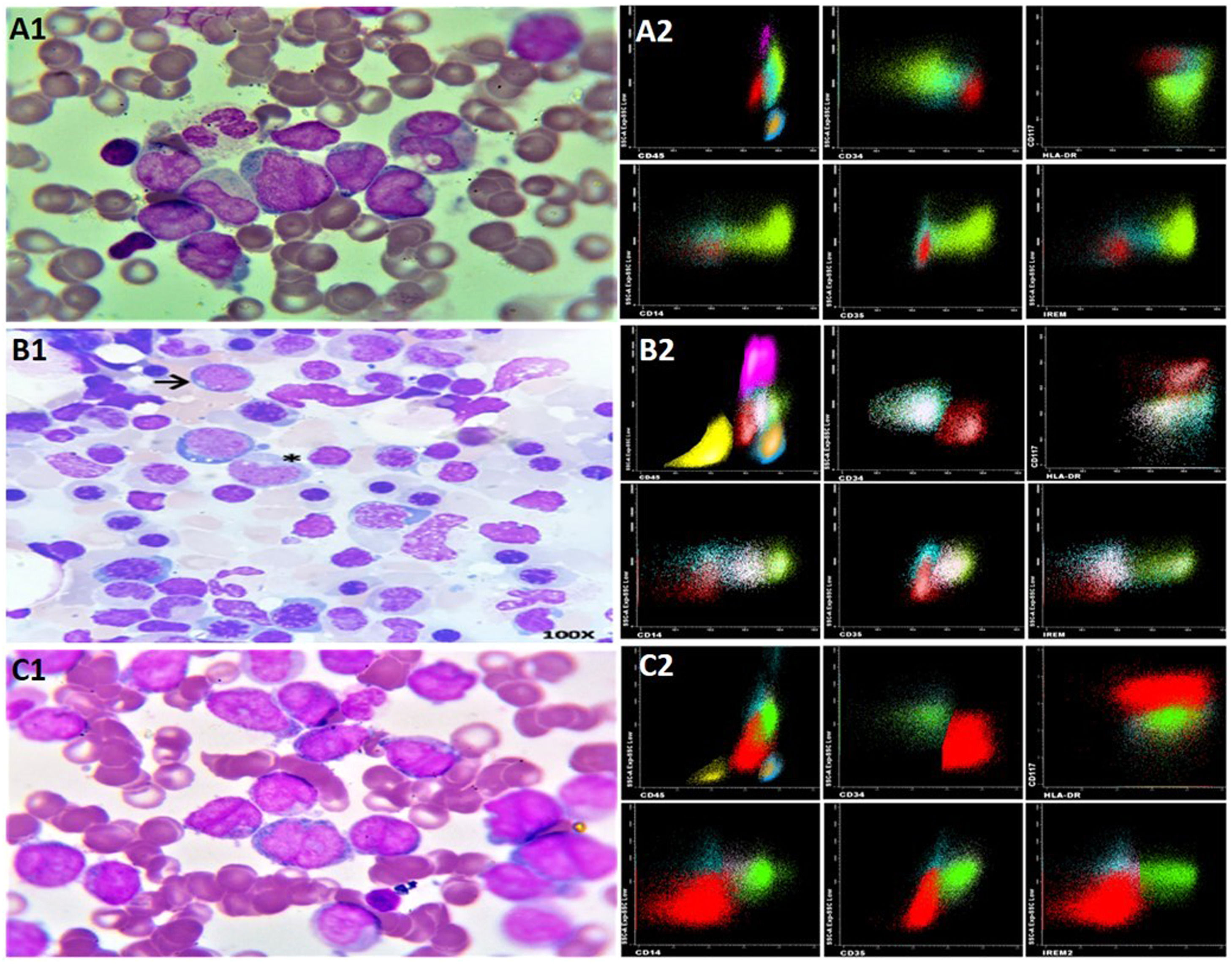 monoblastic leukemia immunophenotype