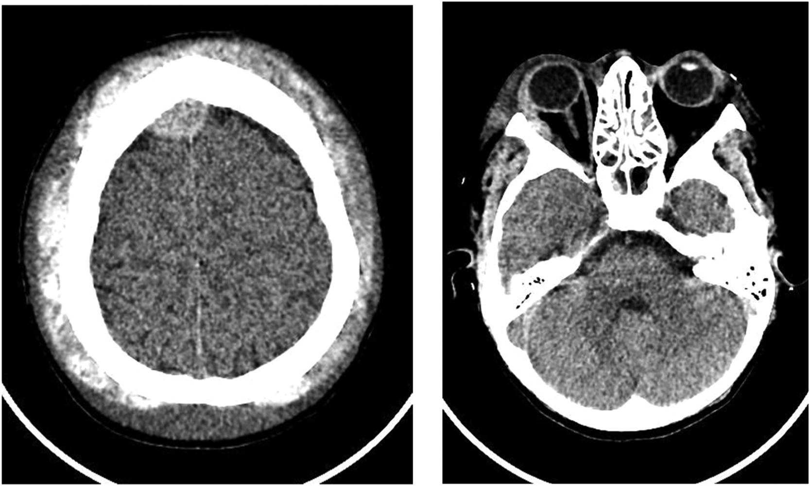 epidural hematoma