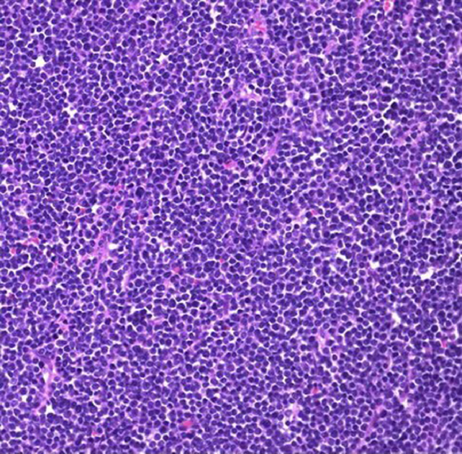 A rare case of B lymphoblastic lymphoma presenting as paraparesis ...