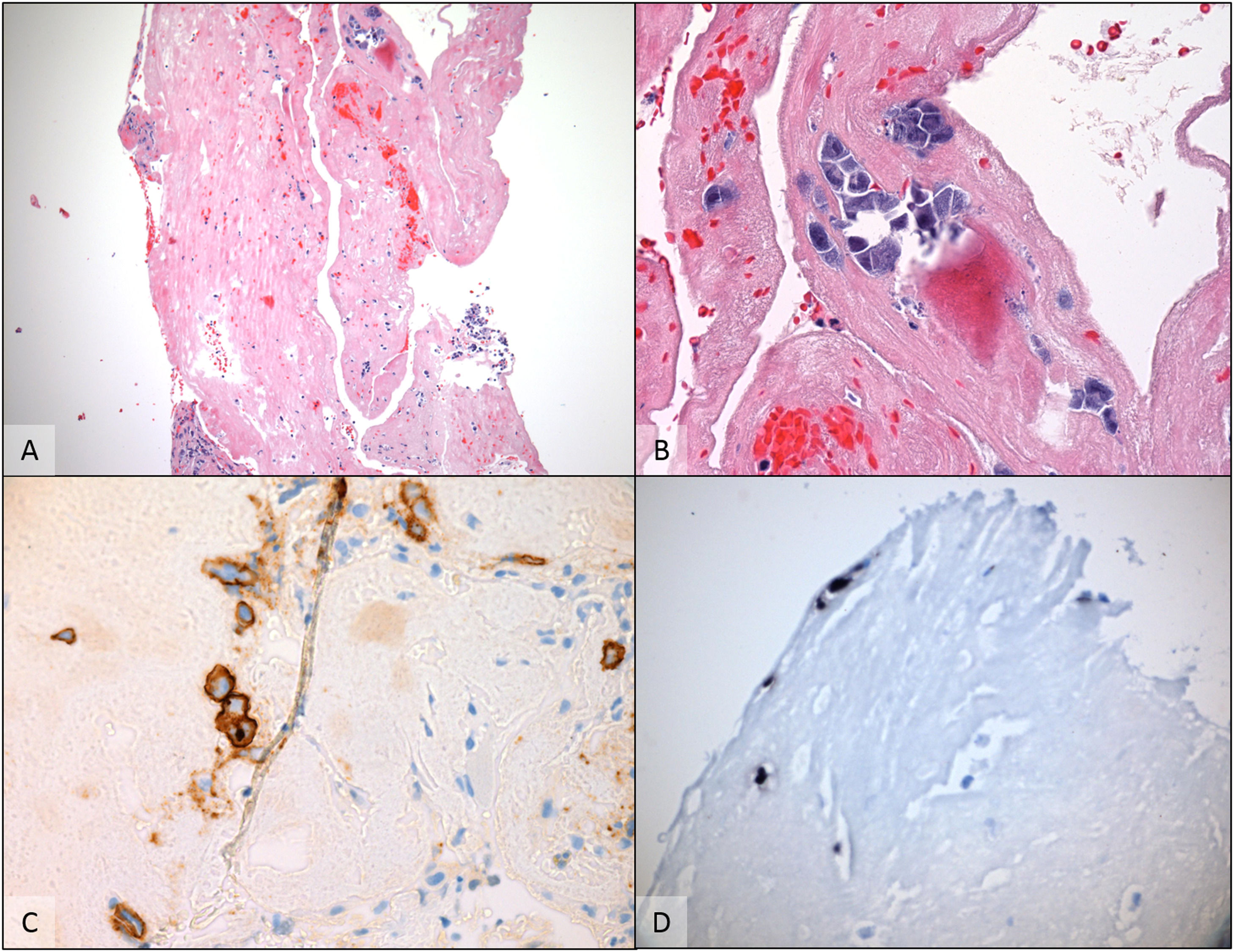The role of autologous bone marrow transplantation in primary effusion ...