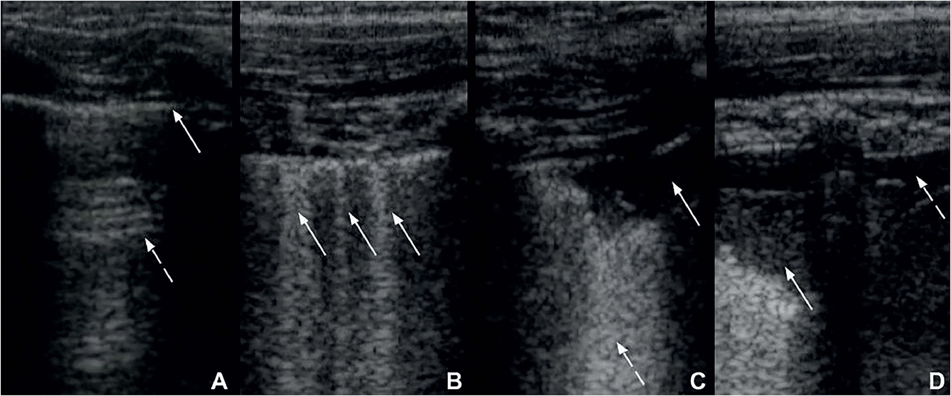 Lung ultrasound score to predict development of acute chest syndrome in ...