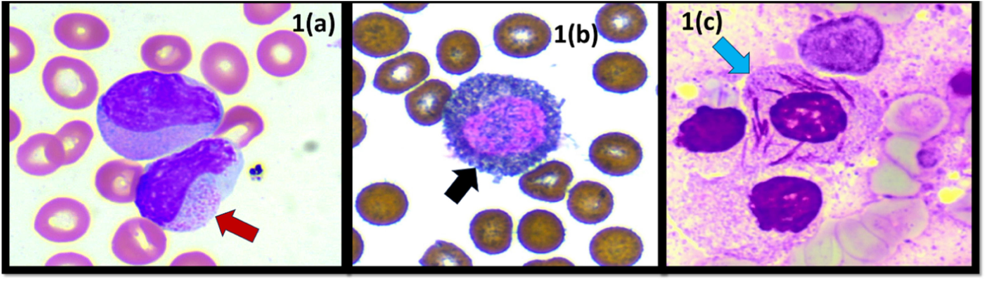 STAT5B::RARα-positive acute promyelocytic leukemia: Role of next ...