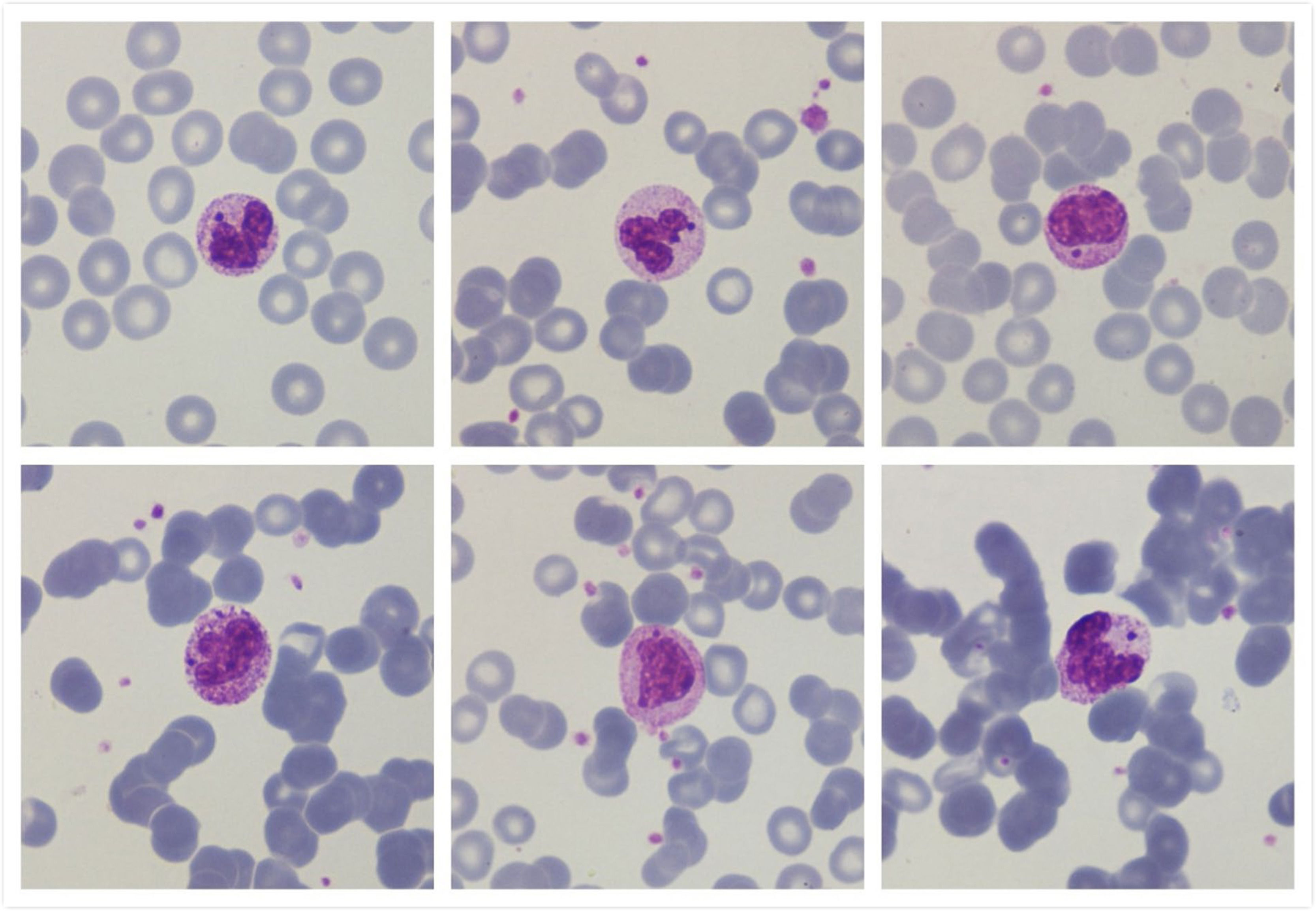 Howell-Jolly-like inclusions in granulocytes of a liver transplant ...