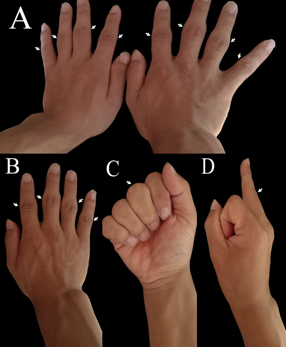 Pachydermodactyly | Medicina Clínica Práctica