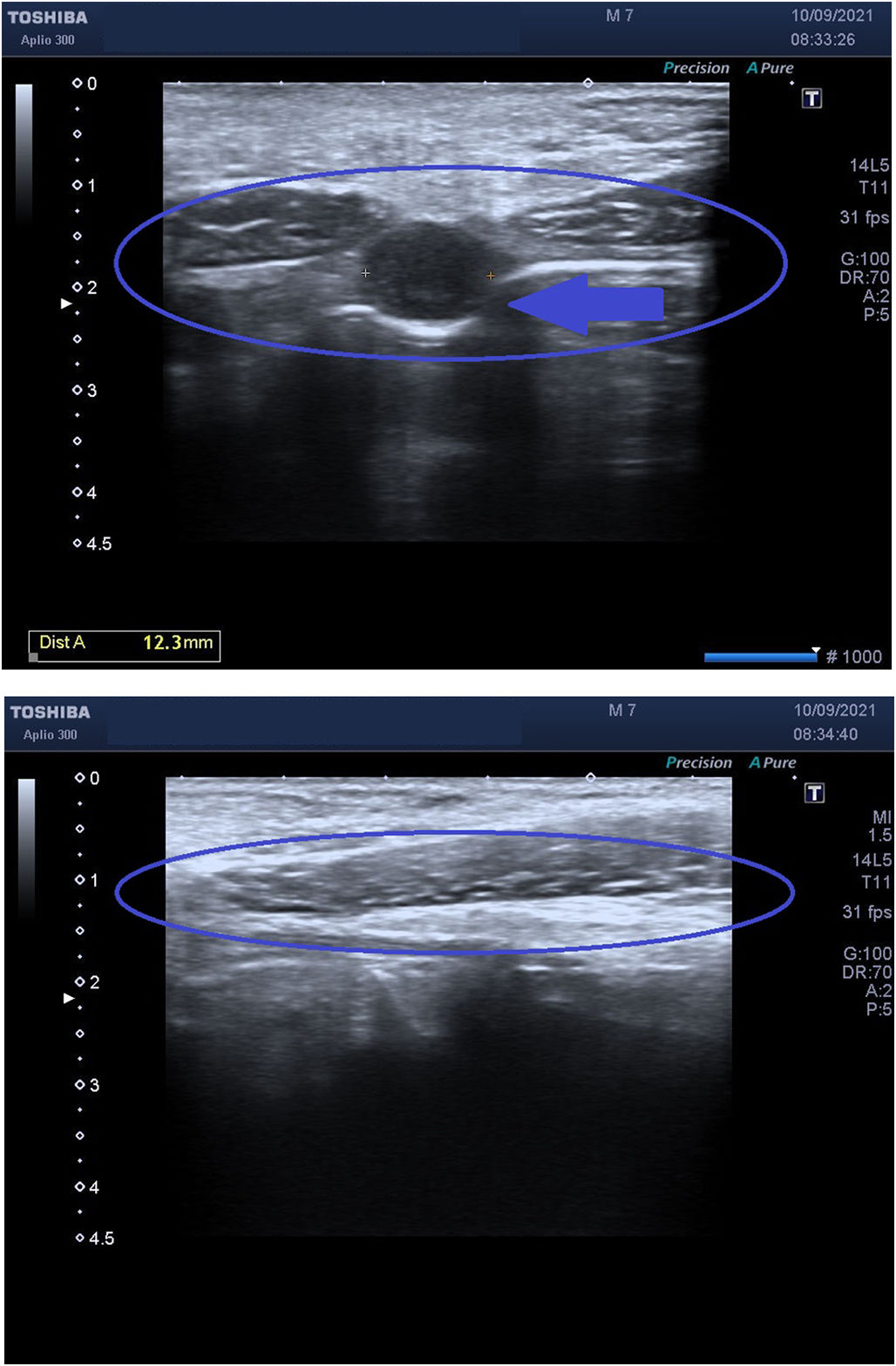 Uraco persistente infectado de presentación tardía | Medicina Clínica ...