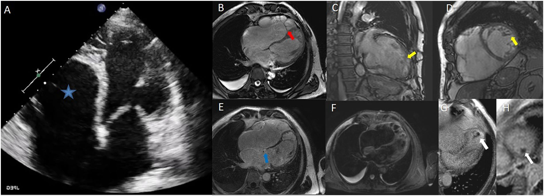 Left ventricular noncompaction cardiomyopathy associated to Ebstein´s ...