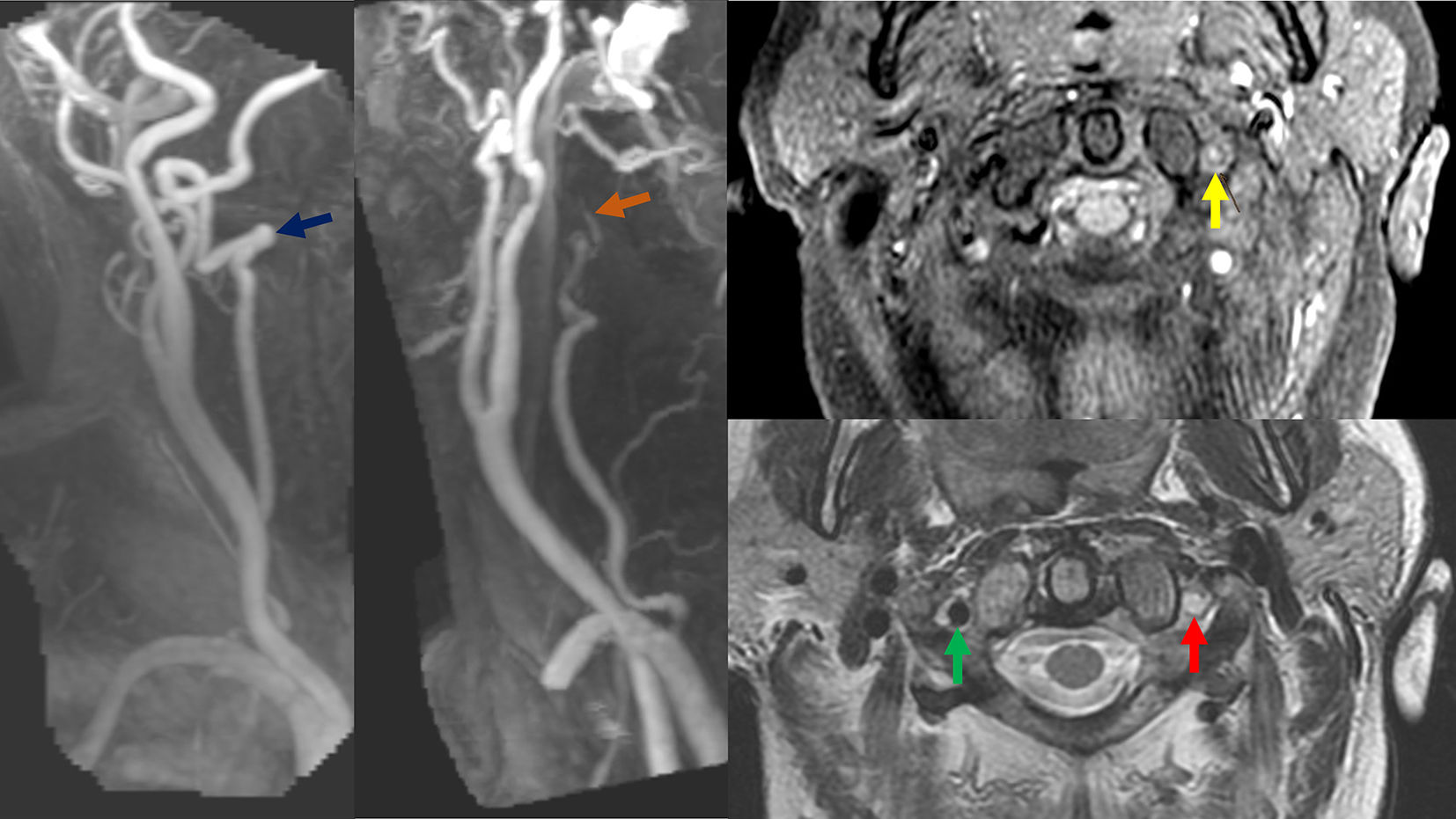 Disección de la arteria vertebral presentándose como síndrome ...