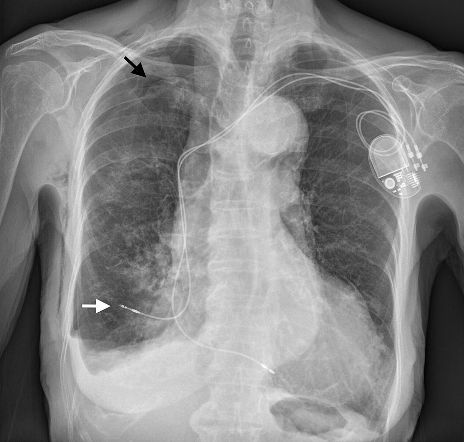 Uncommon complication of late perforation of the right atrium with ...