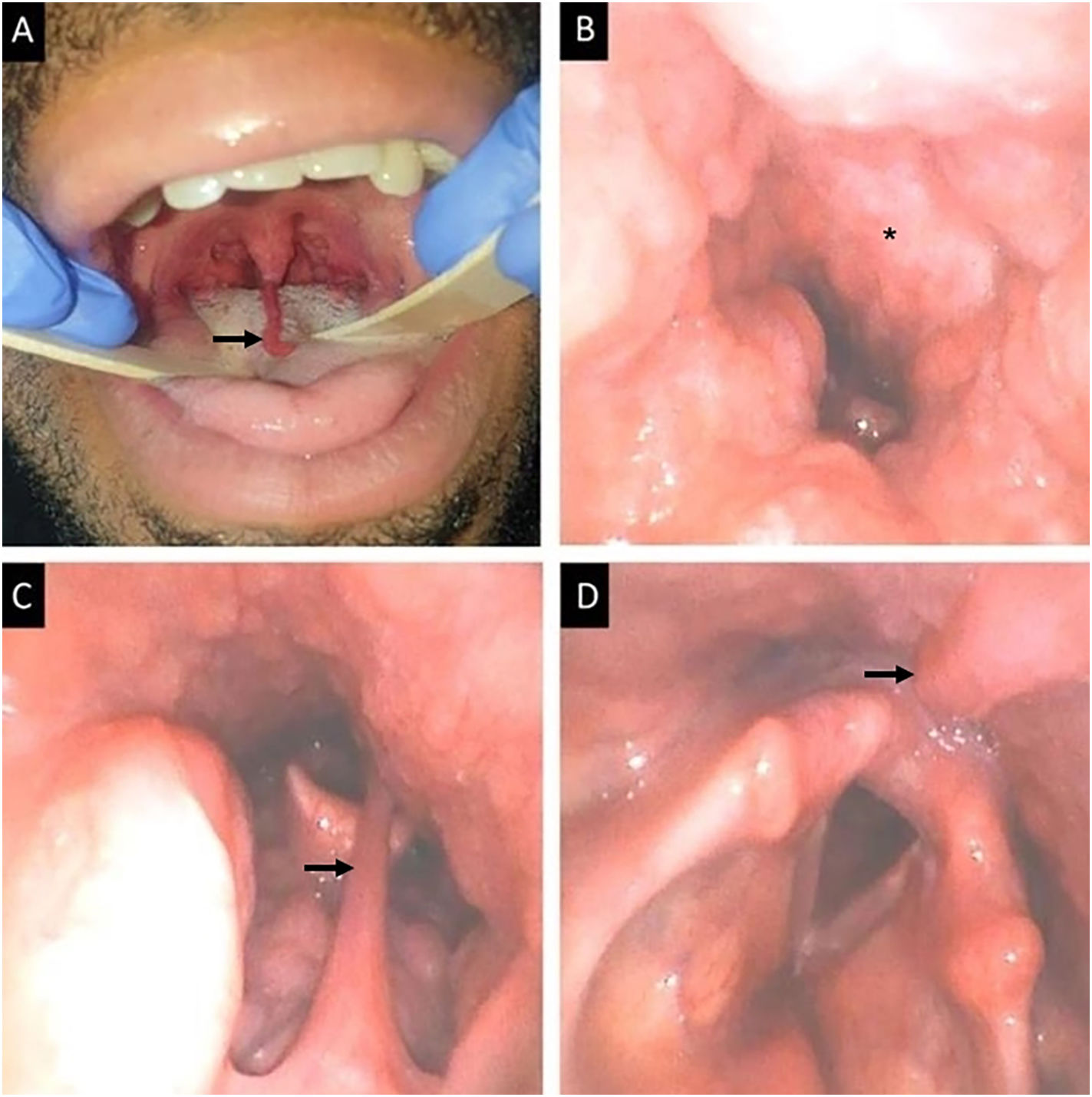 uvula increase in length