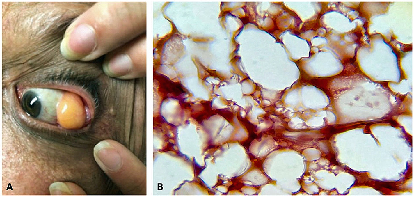 Conjunctival dermolipoma | Medicina Clínica Práctica