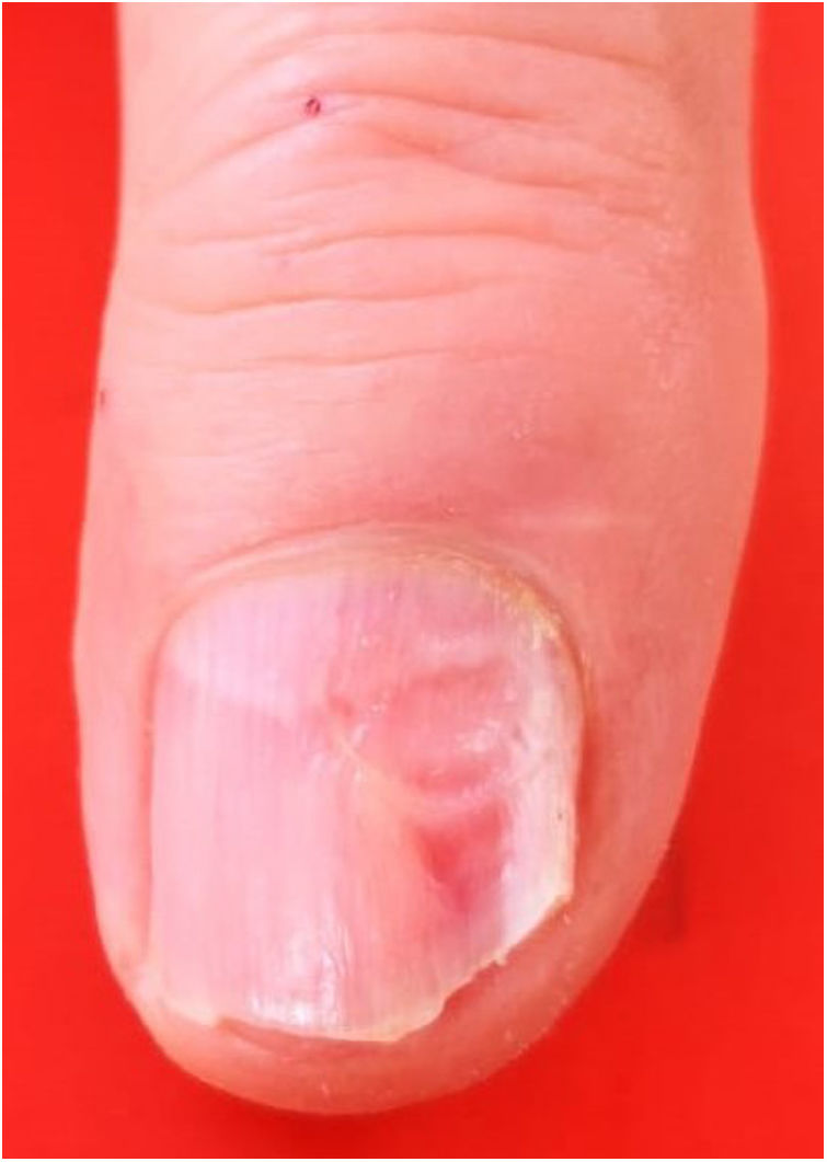 Onychodystrophy secondary to a digital myxoid cyst | Atención Primaria ...