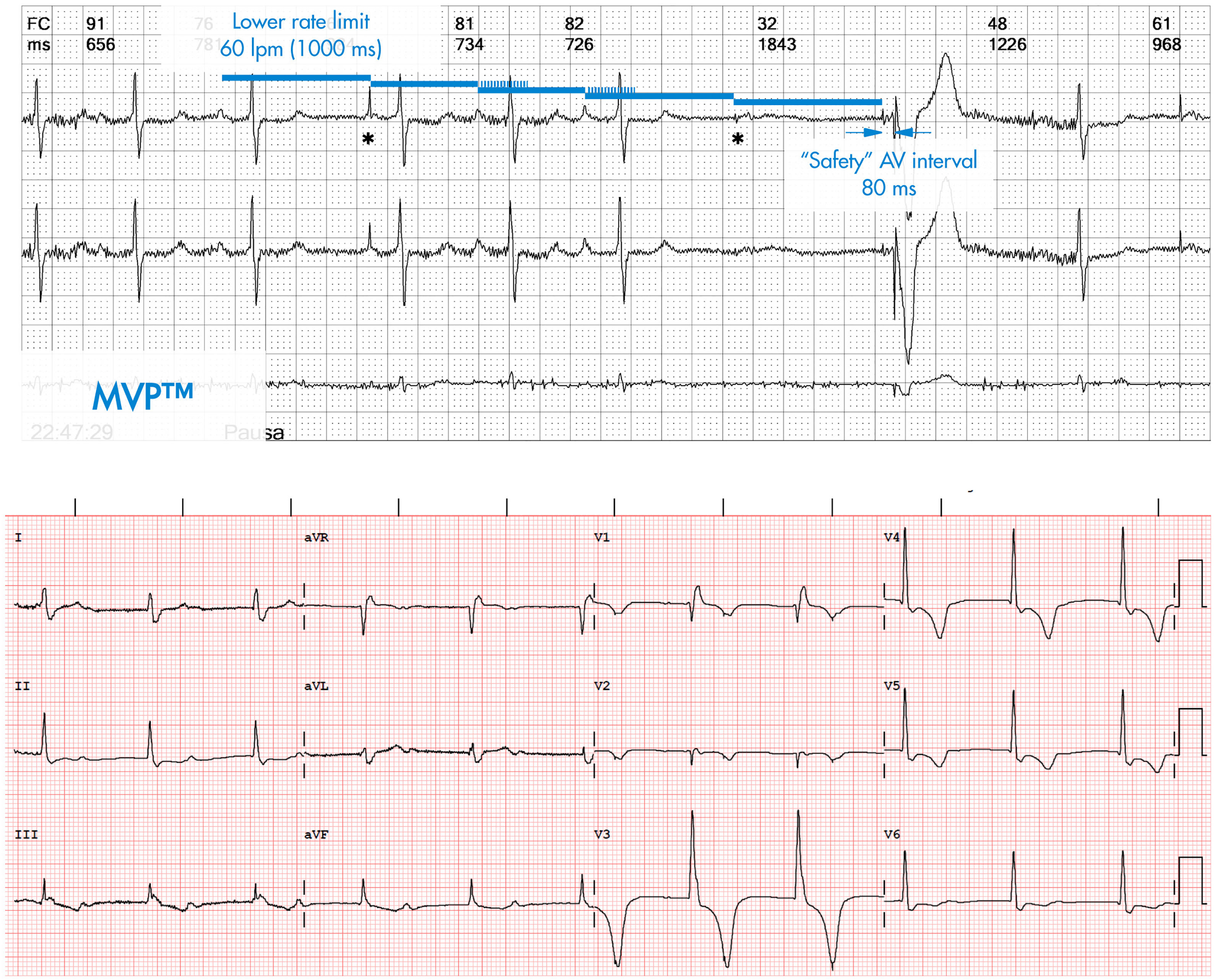Advanced pacing algorithms resembling device malfunction: A ...
