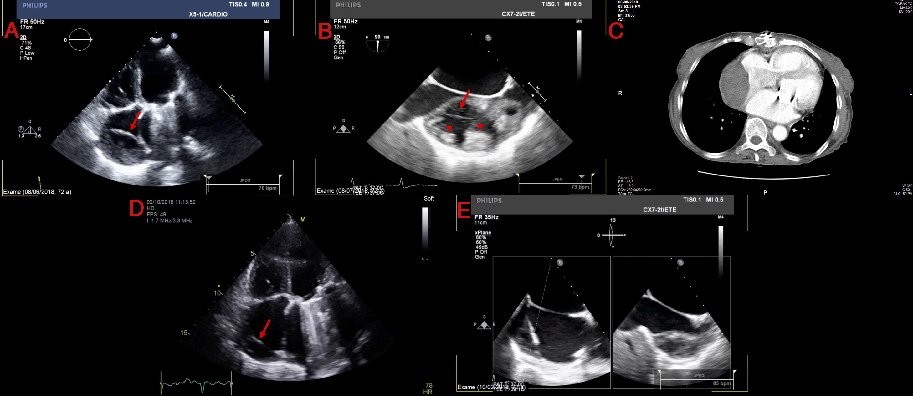 Right atrial dissection: a rare and silent complication | REC ...