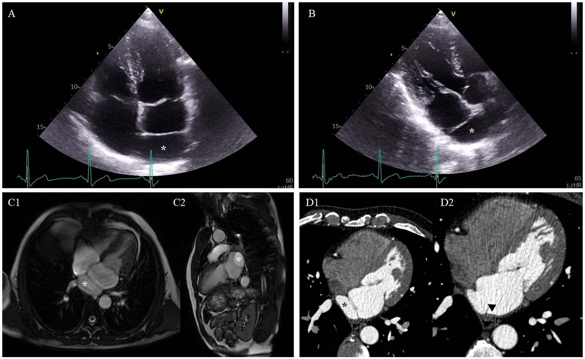Cor triatriatum sinistrum in adulthood: A case report | REC: CardioClinics