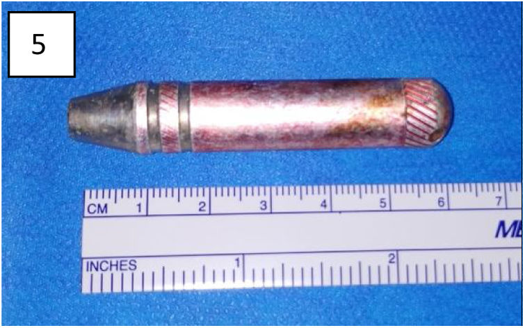 A 6cm Metal Crack Pipe Aspirated | Open Respiratory Archives