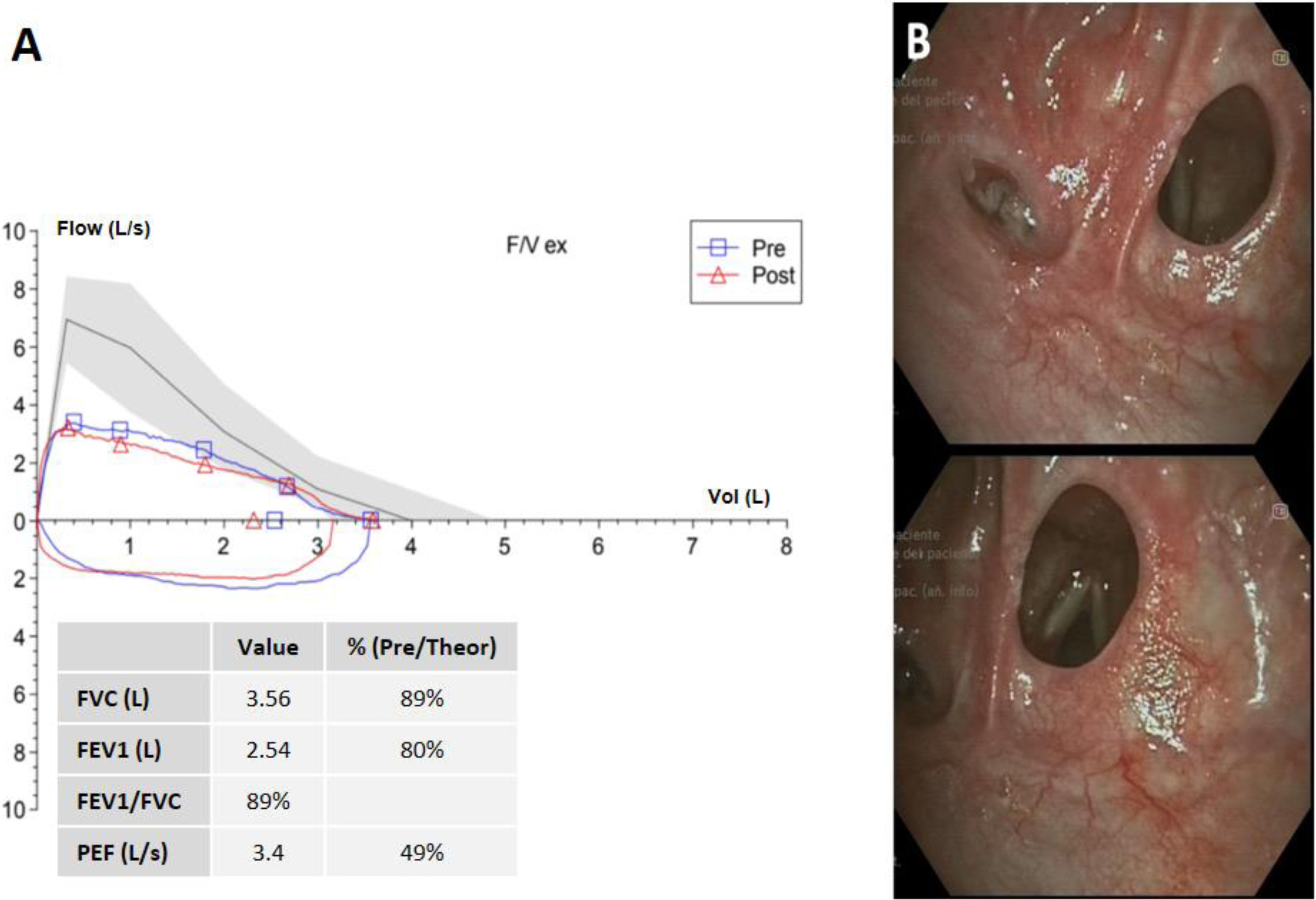 Supraglottic Stenosis After Caustic Ingestion | Open Respiratory Archives