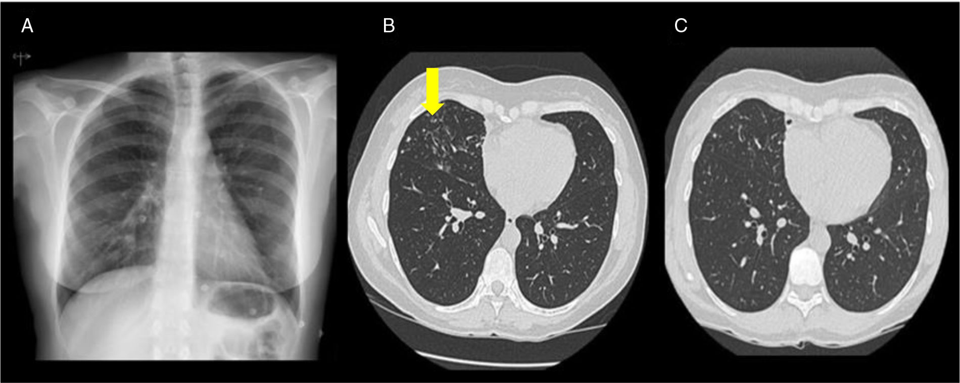 Treatment-Refractory Mycobacterium avium Complex Pulmonary Disease: A ...
