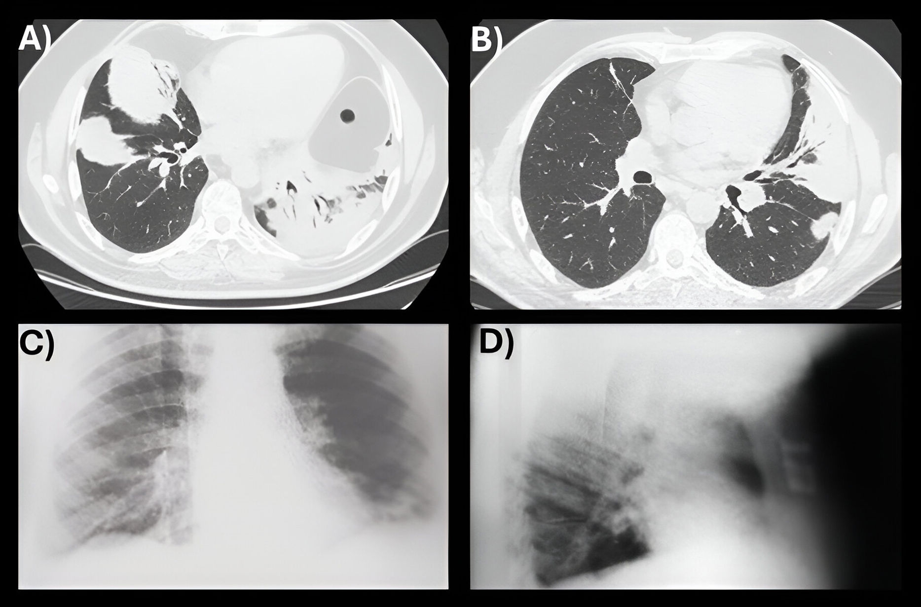 Organizing Pneumonia Associated With Subclinical HSV Extrapulmonary ...