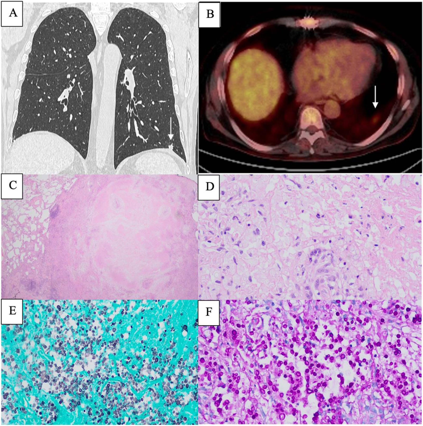 Spiculated Nodule in a Lung Transplant Recipient: Localized ...