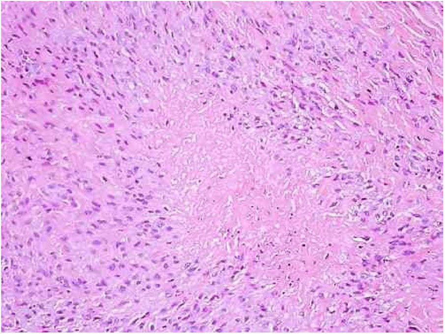 Caso para diagnóstico. Nódulos subcutâneos em região plantar | Anais ...