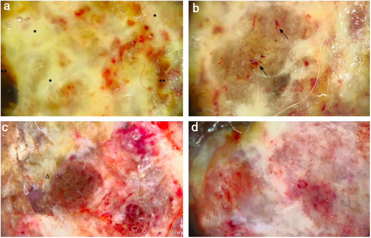 Massa exofítica semelhante a couve‐flor na pele: melanoma polipoide ...