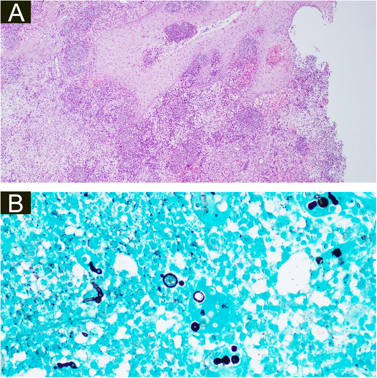 Dermatofitose profunda causada por Trichophyton rubrum em pacientes ...