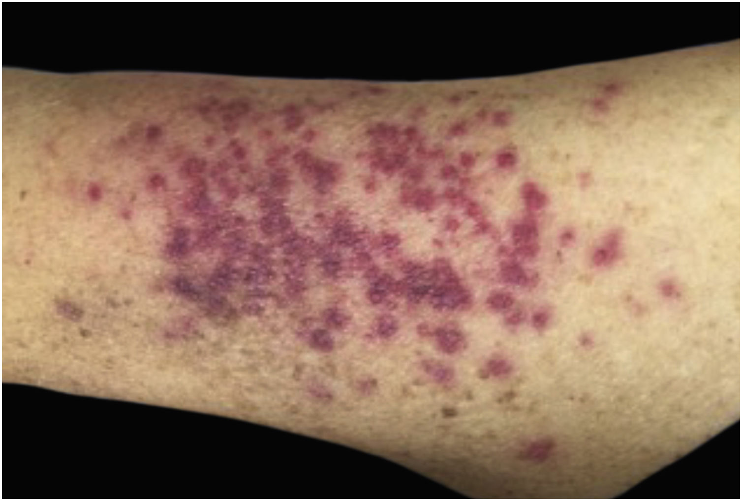 Manifestações dermatológicas das neoplasias hematológicas. Parte I ...