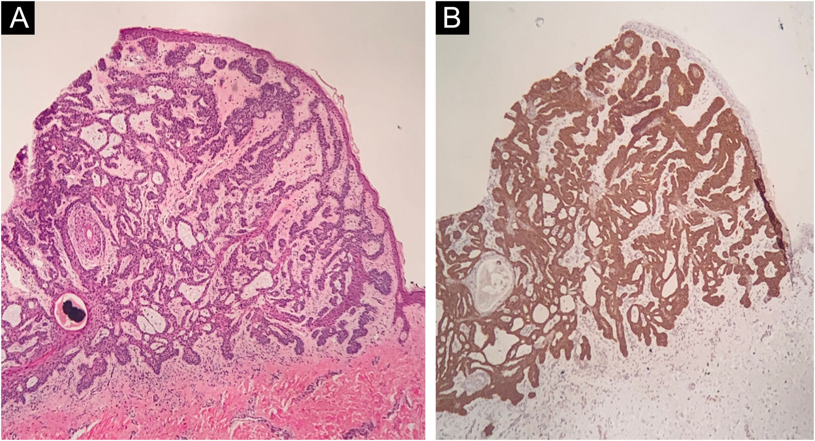 Fibroepitelioma de Pinkus – Microscopia confocal no auxílio diagnóstico ...