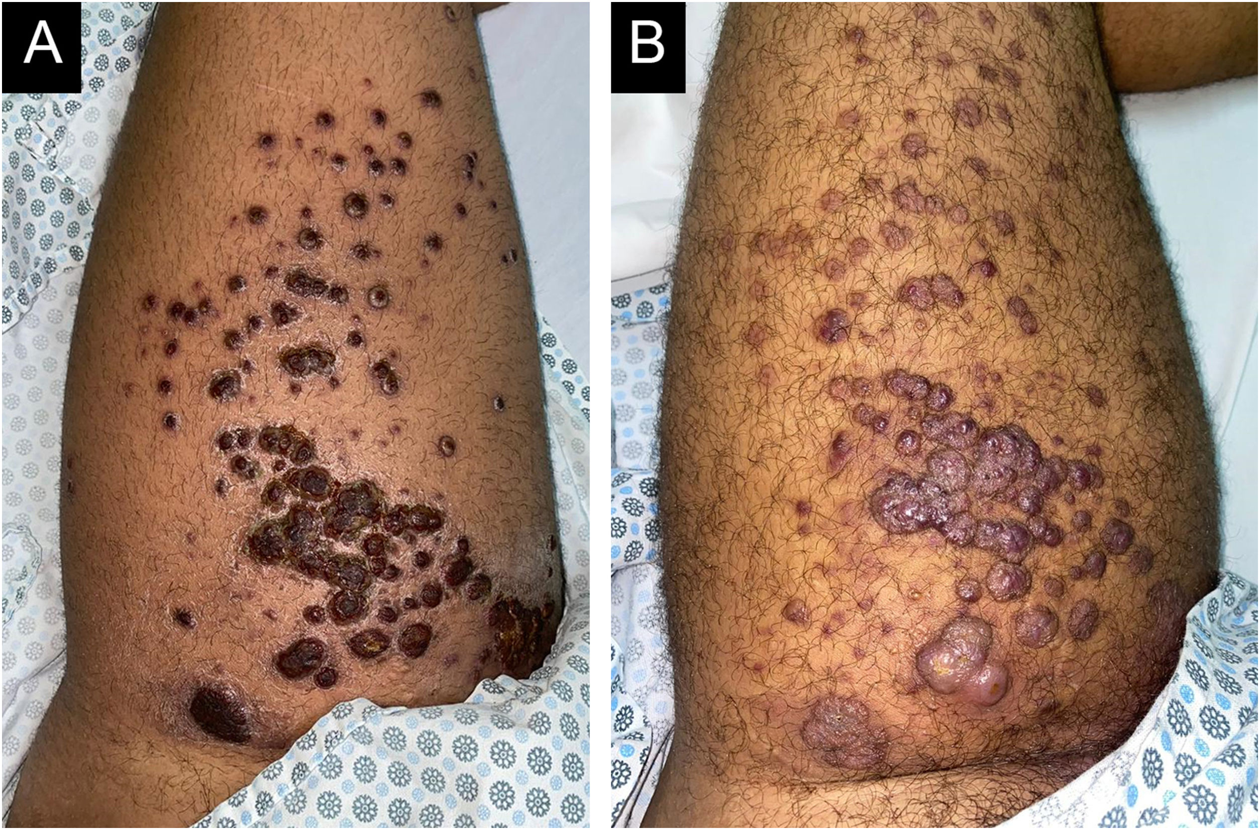Sarcoma de Kaposi sobre cicatrizes de Mpox – Relato de caso | Anais ...