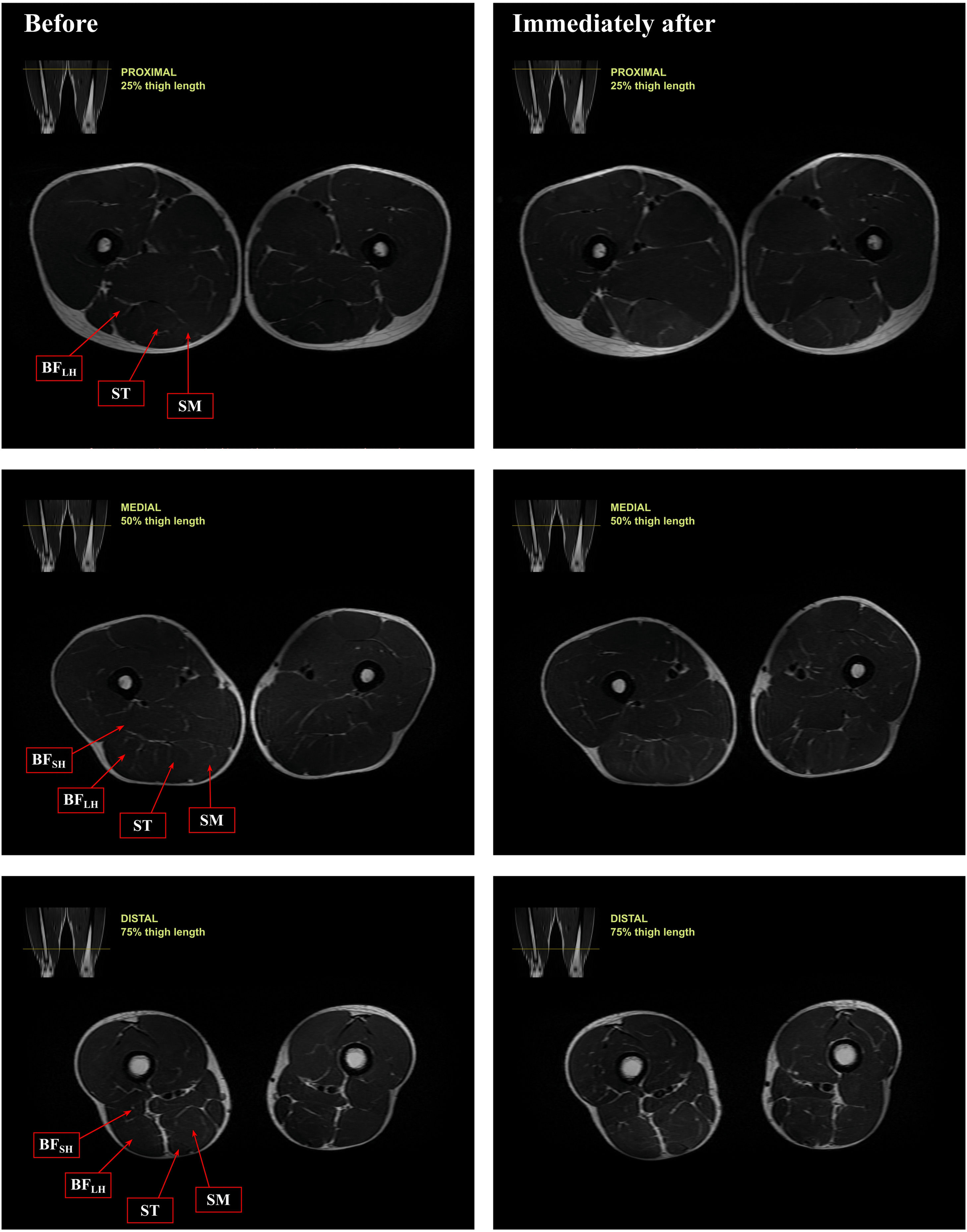 Individual and region-specific hamstring muscles use during a novel ...