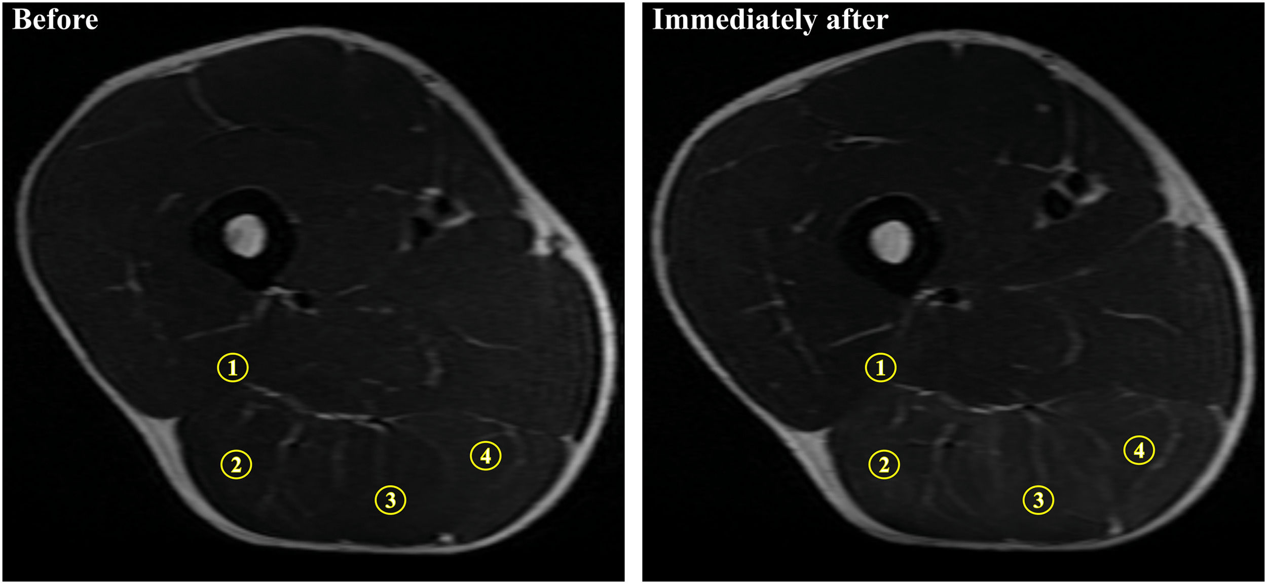 Individual and region-specific hamstring muscles use during a novel ...