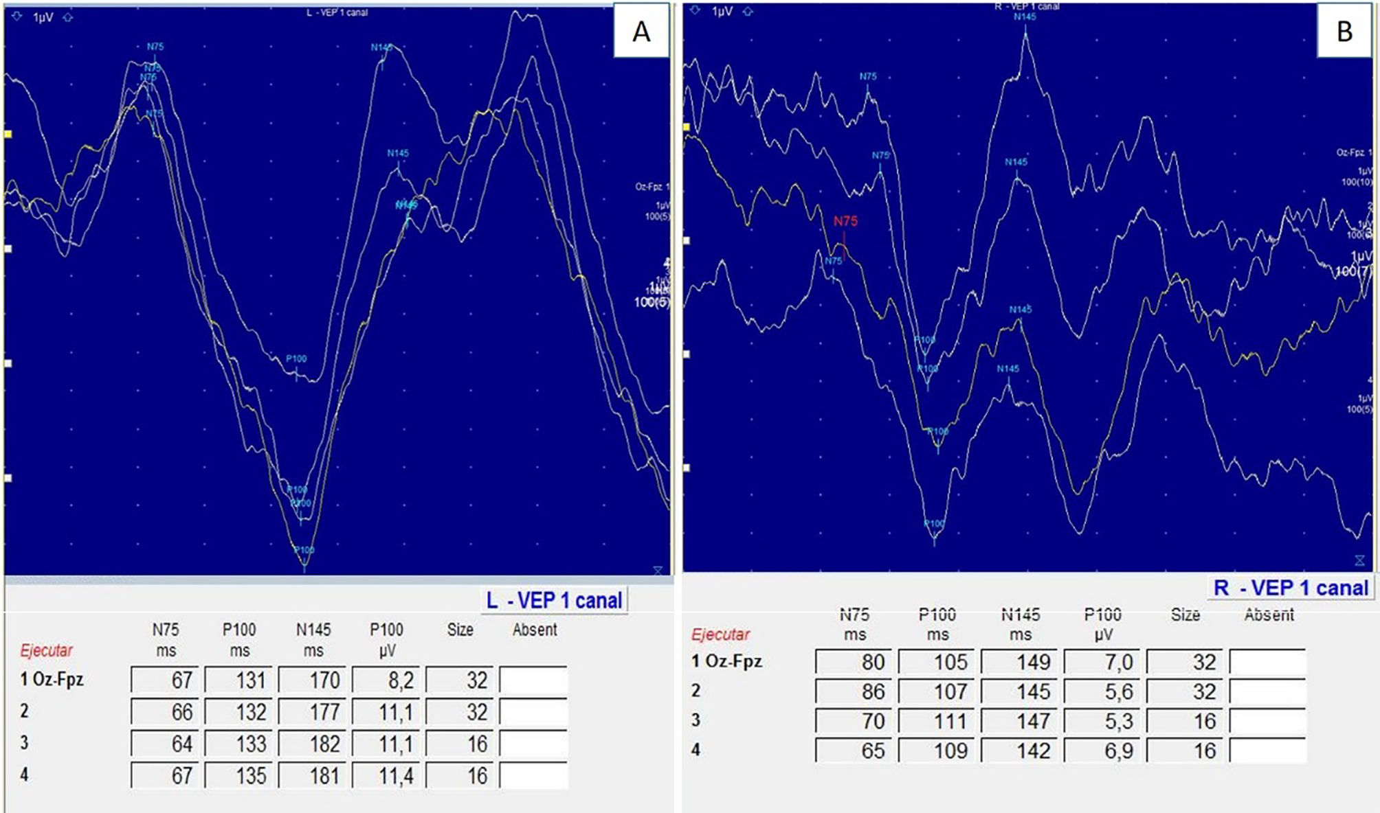 Sensitivity and specificity of visual evoked potentials for early ...
