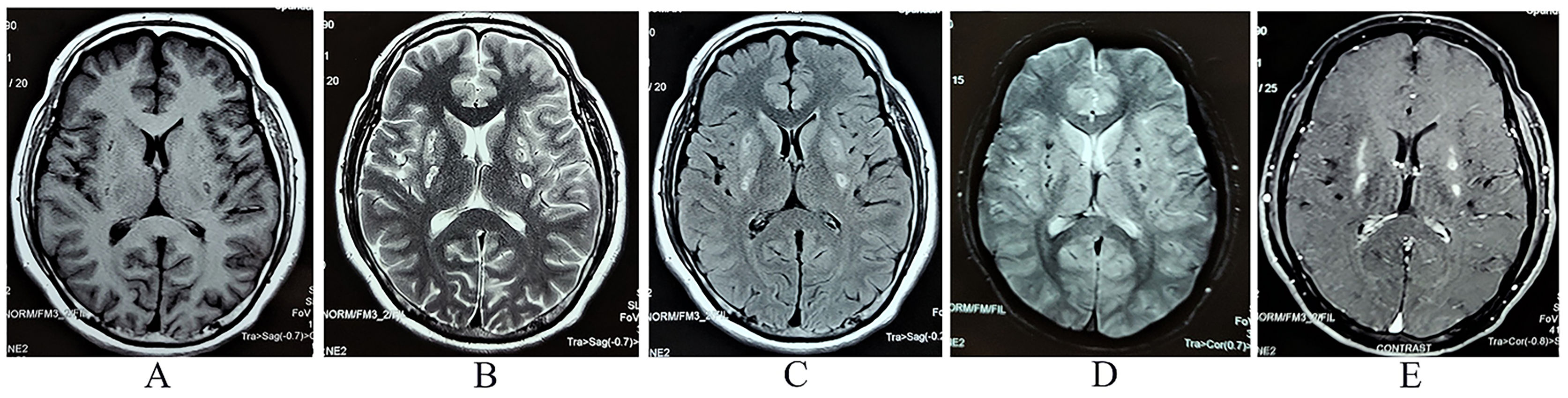 Multifocal neuraxial involvement in acute methanol intoxication: A ...