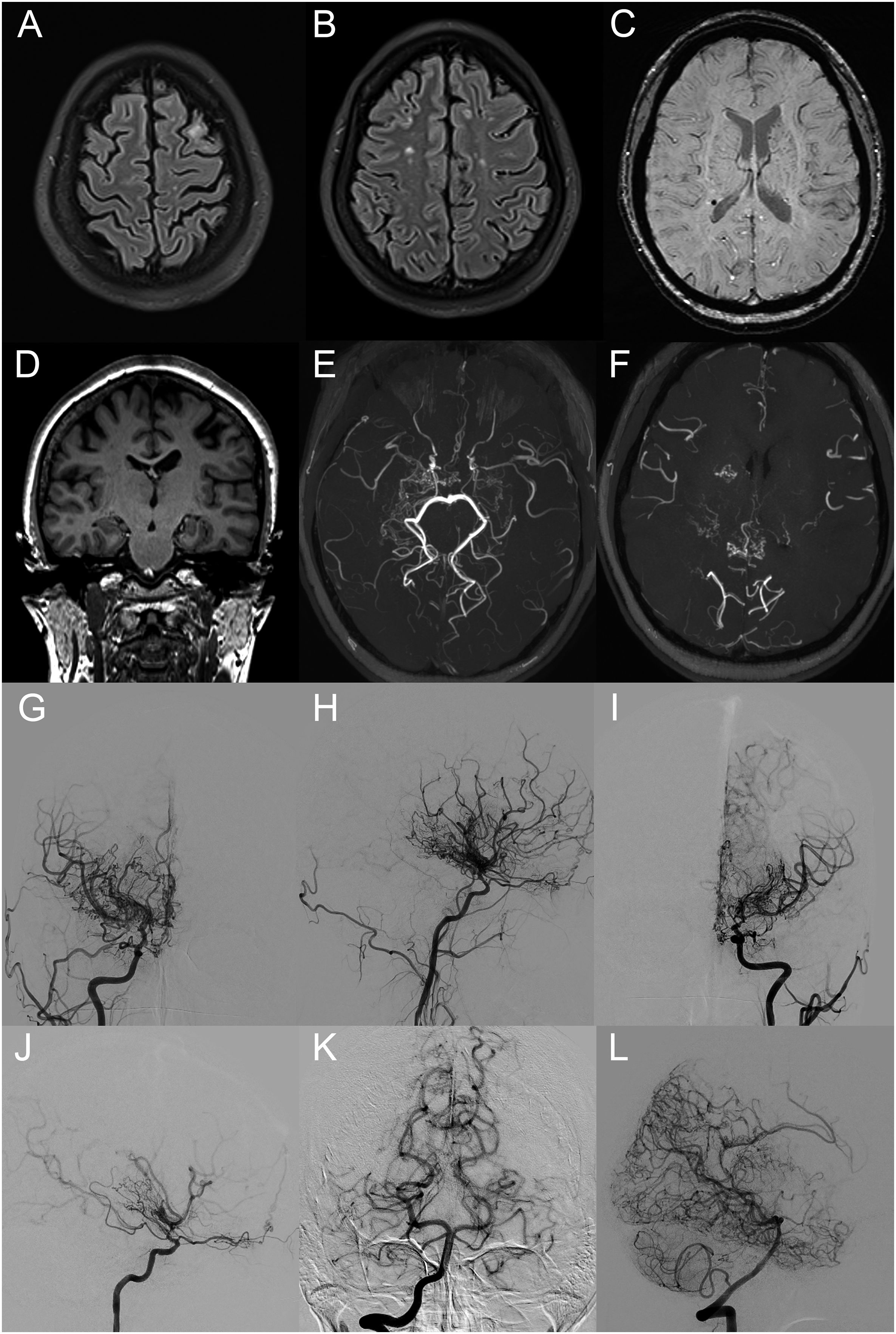 Moyamoya disease and paranoid schizophrenia: Causality or casualty ...