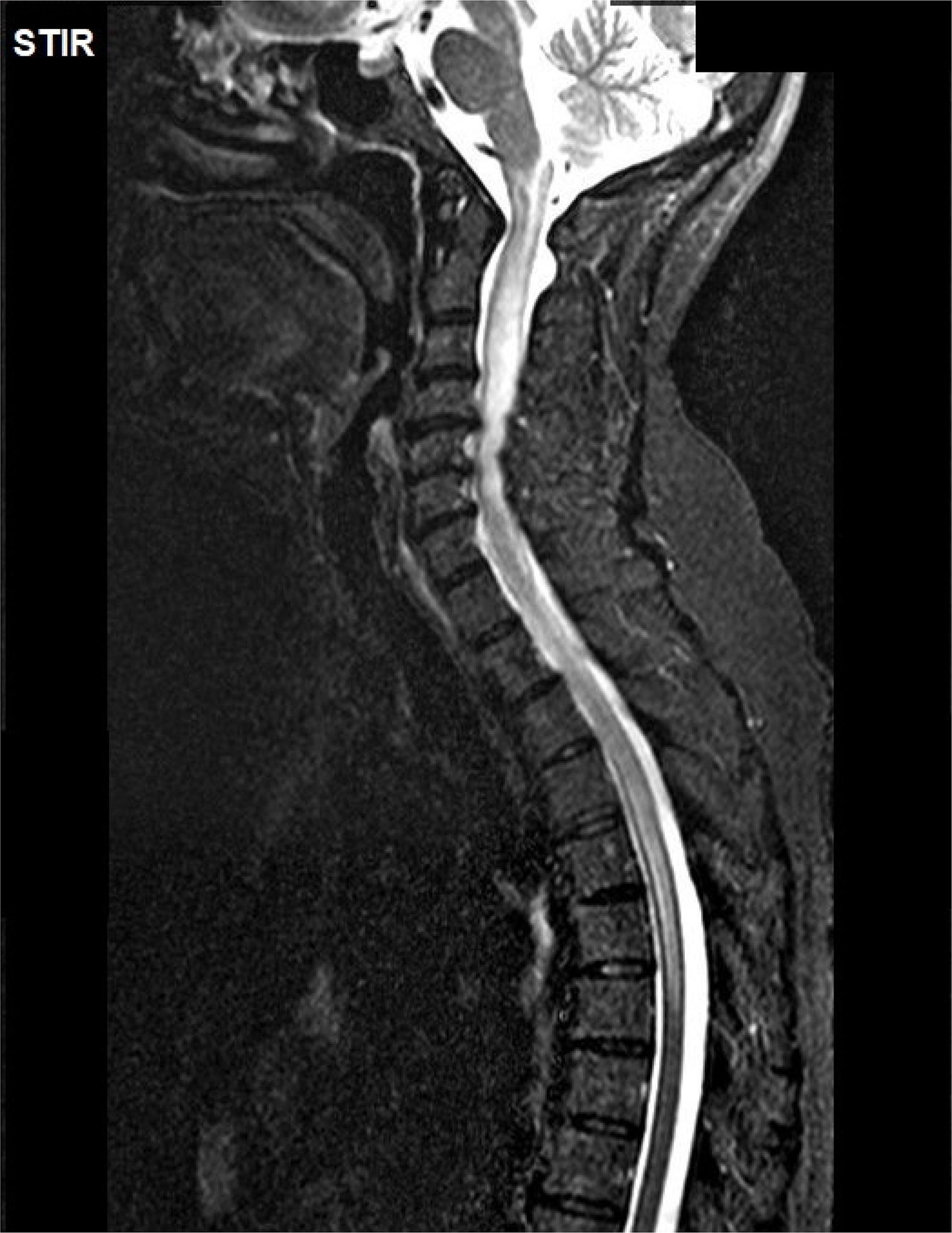 Longitudinally extensive transverse myelitis in patient with latent and ...