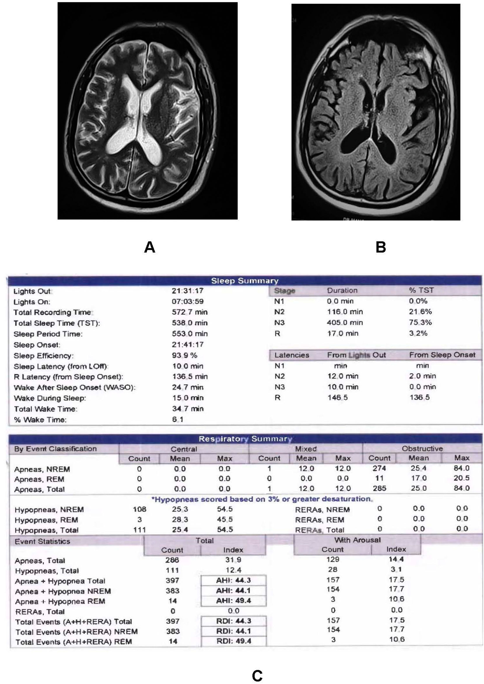 Obstructive sleep apnea induced bilateral tonic- clonic seizure of ...